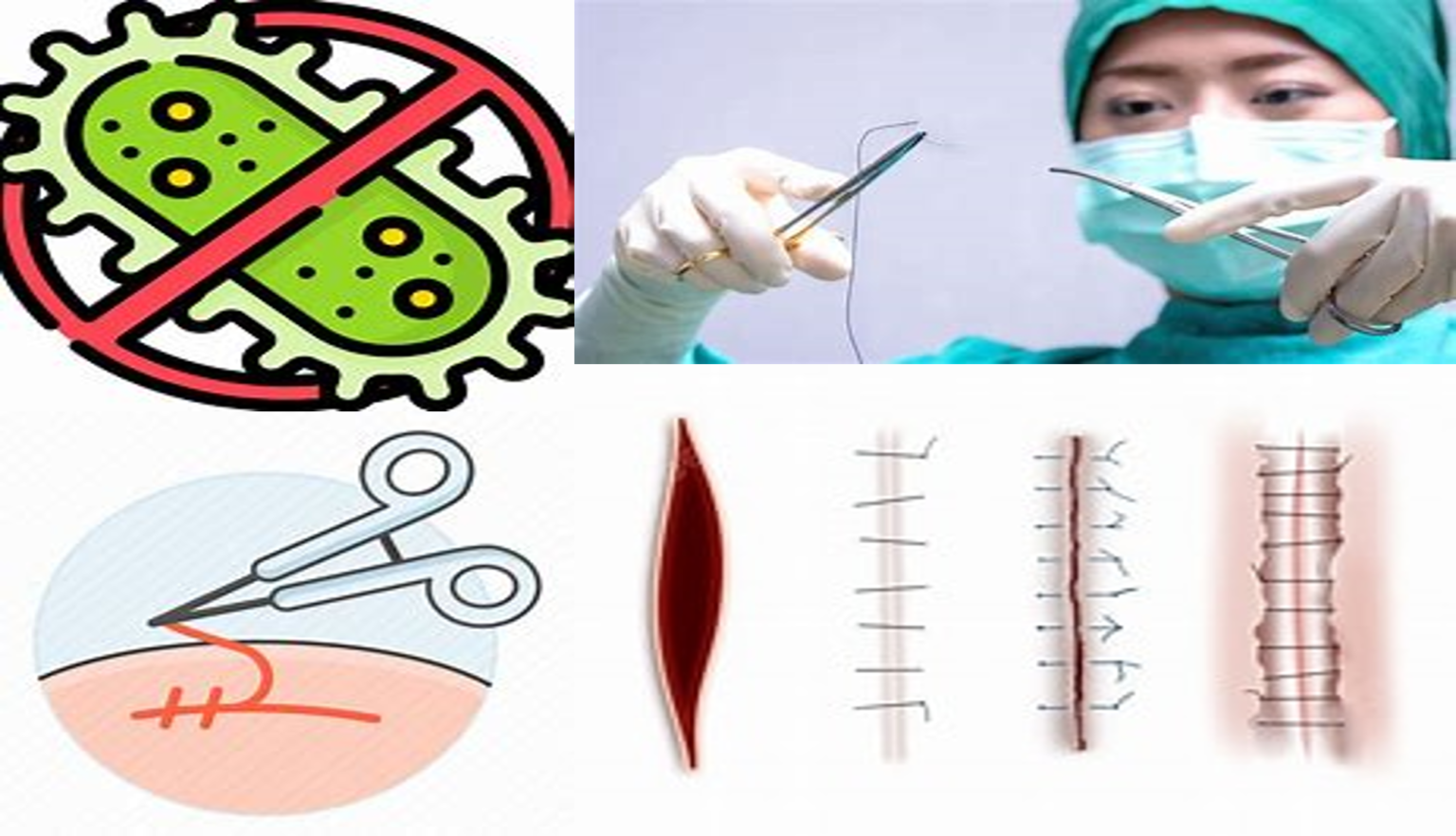 Enhancing Surgical Sutures with Antibacterial Finishes